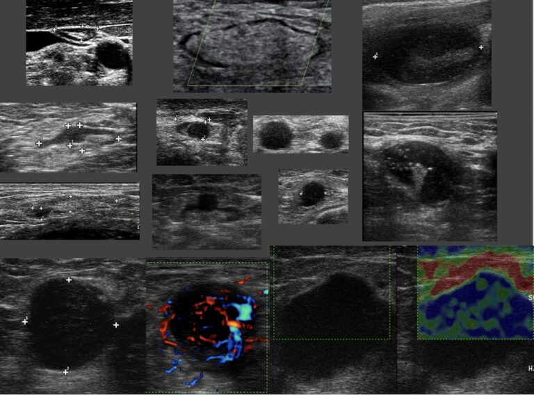 LN-RADS CASES – Lymph Node Reporting and Data System (LN-RADS)