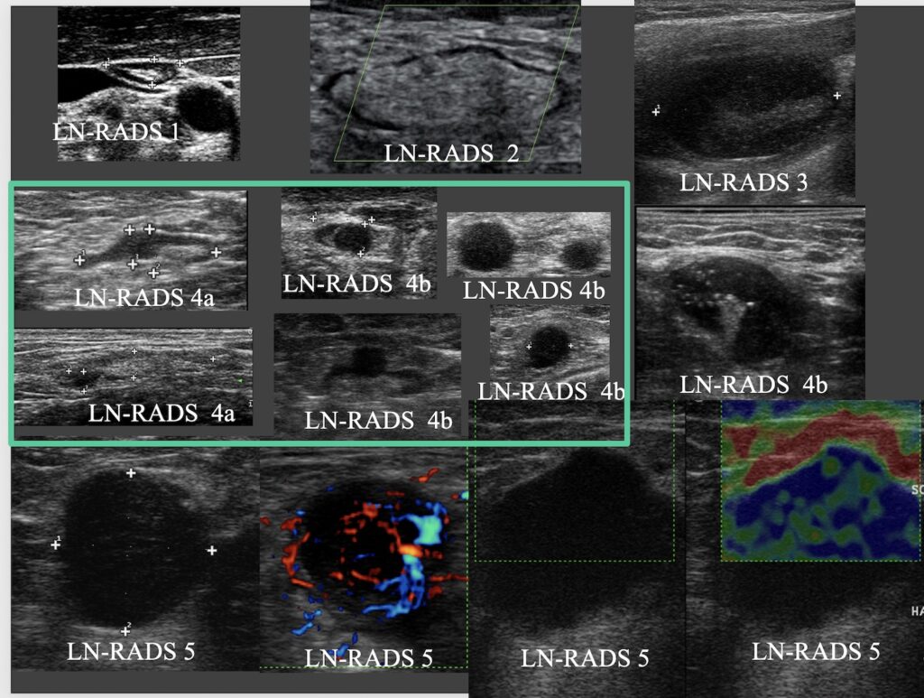 Lymph Node Reporting and Data System (LN-RADS) – Lymph Node Reporting ...