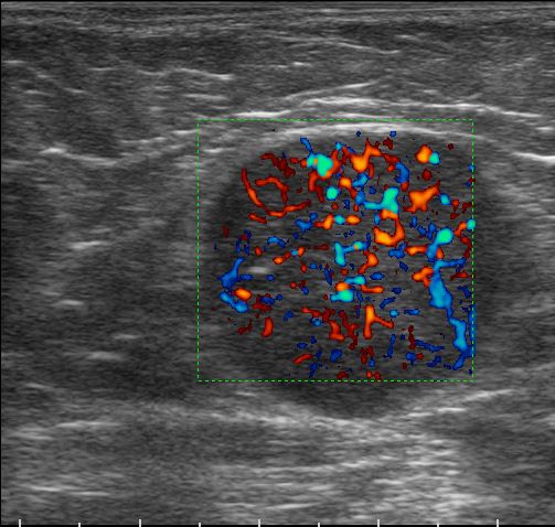 E-training – Lymph Node Reporting and Data System (LN-RADS)