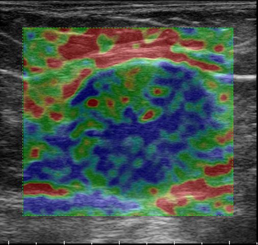 Melanoma malignum – Lymph Node Reporting and Data System (LN-RADS)