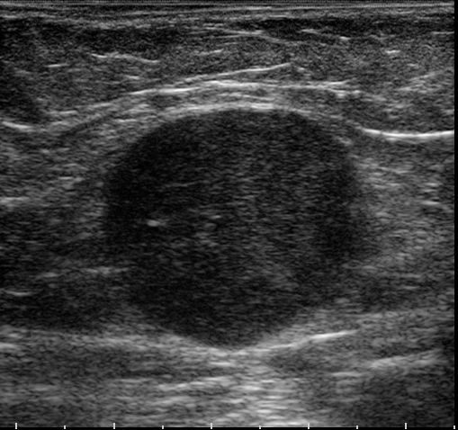 E-training – Lymph Node Reporting and Data System (LN-RADS)