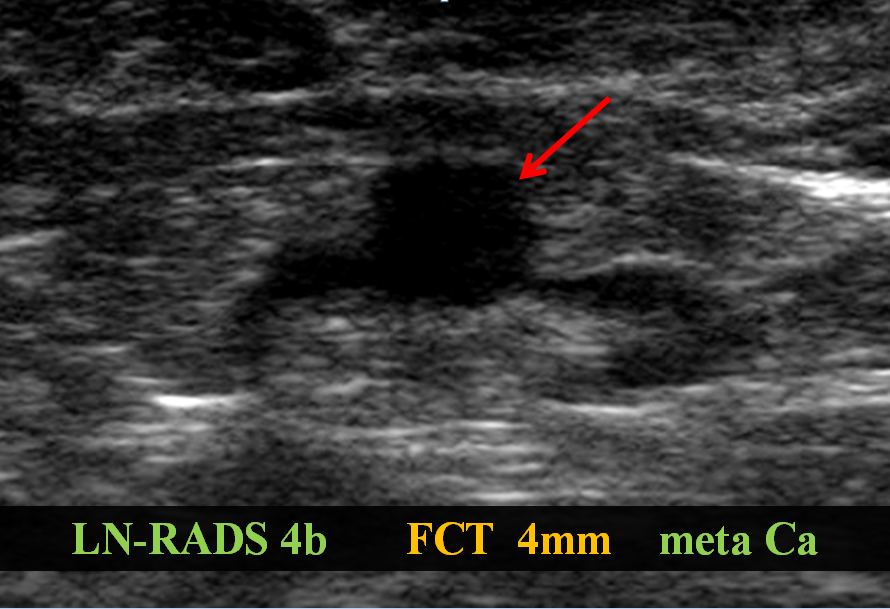 Lymph Node Reporting and Data System (LN-RADS) – Lymph Node Reporting ...