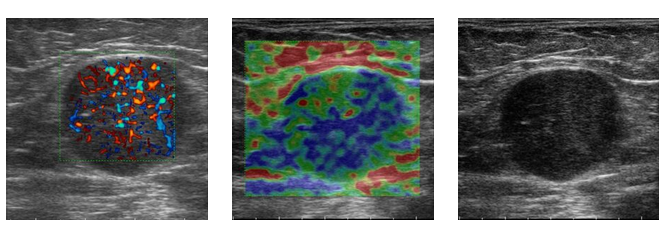 Melanoma malignum – Lymph Node Reporting and Data System (LN-RADS)